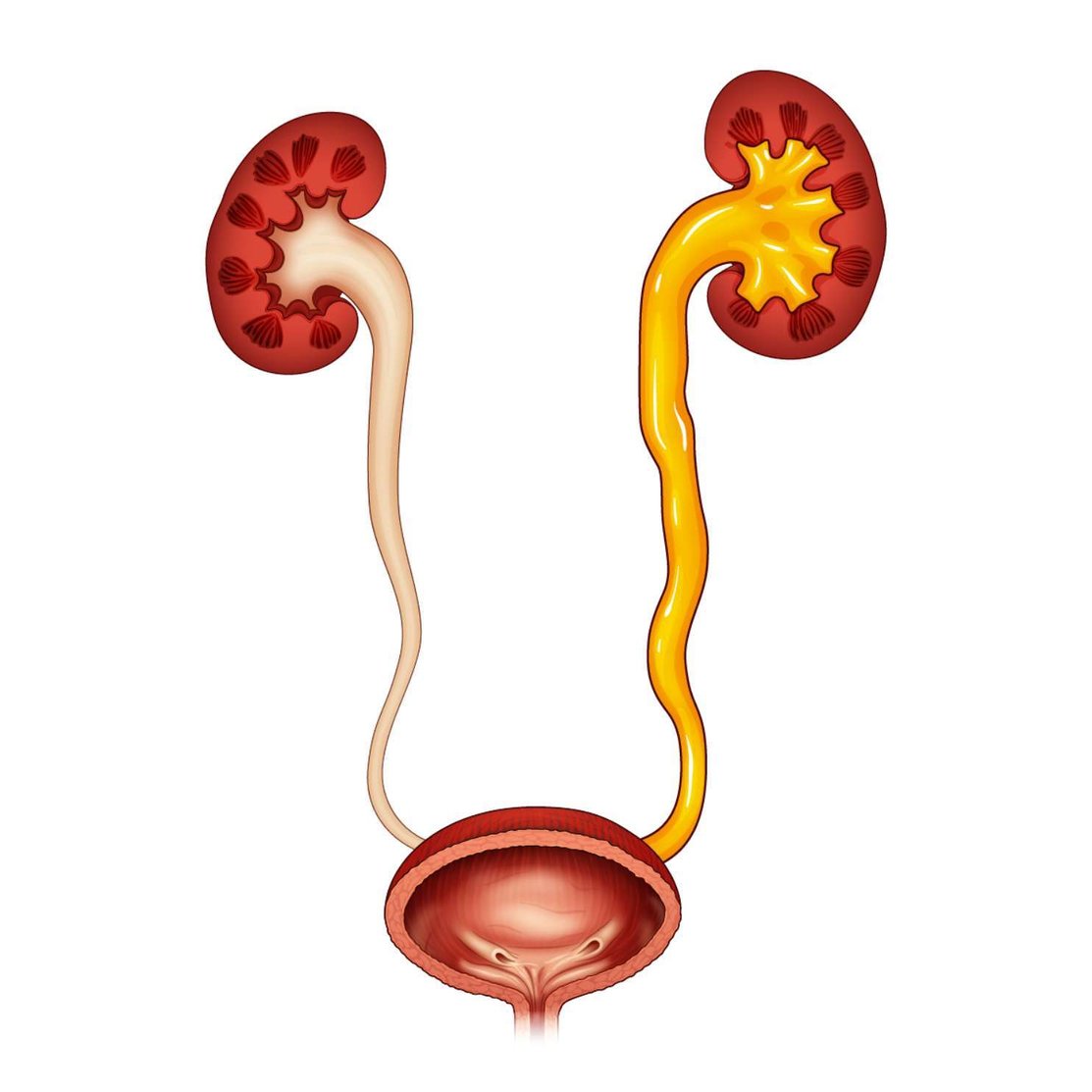 Understanding VUR Grade 4 and it’s Treatment Options