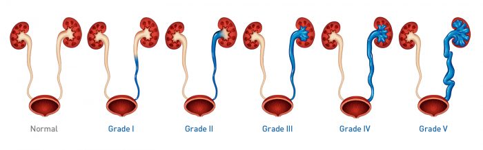 VUR Grading 1-5 | How the Scale Describes VUR