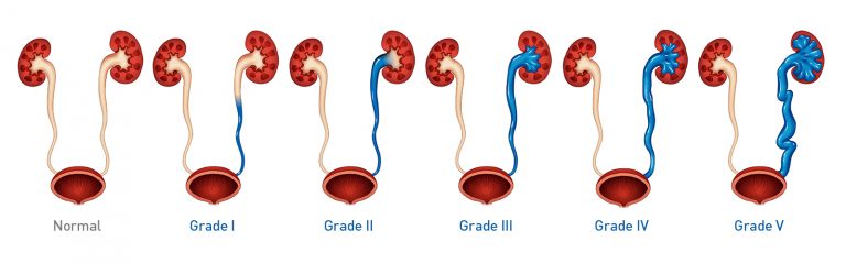 How is VUR diagnosed and graded? - Deflux