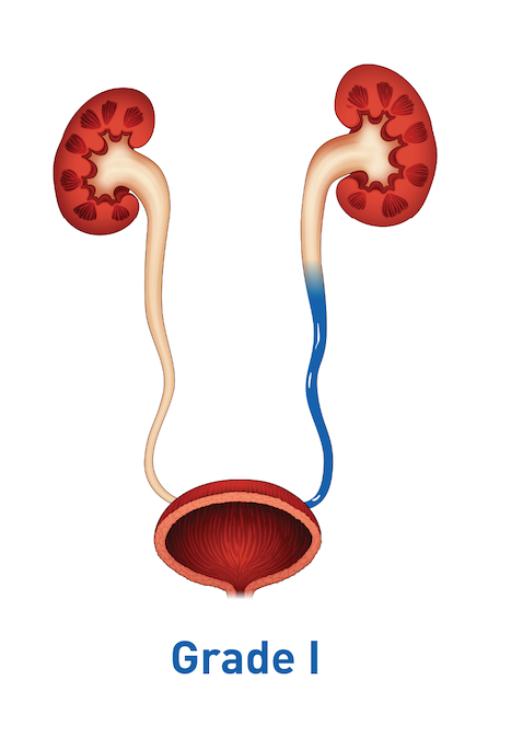 Understanding VUR Grade 1 and it’s Treatment Options